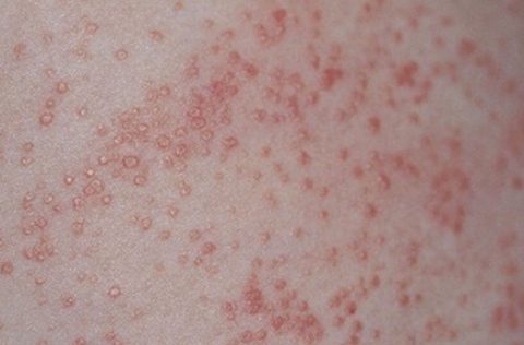 Prakaitinis bėrimas - Dermatologo konsultacija internetu