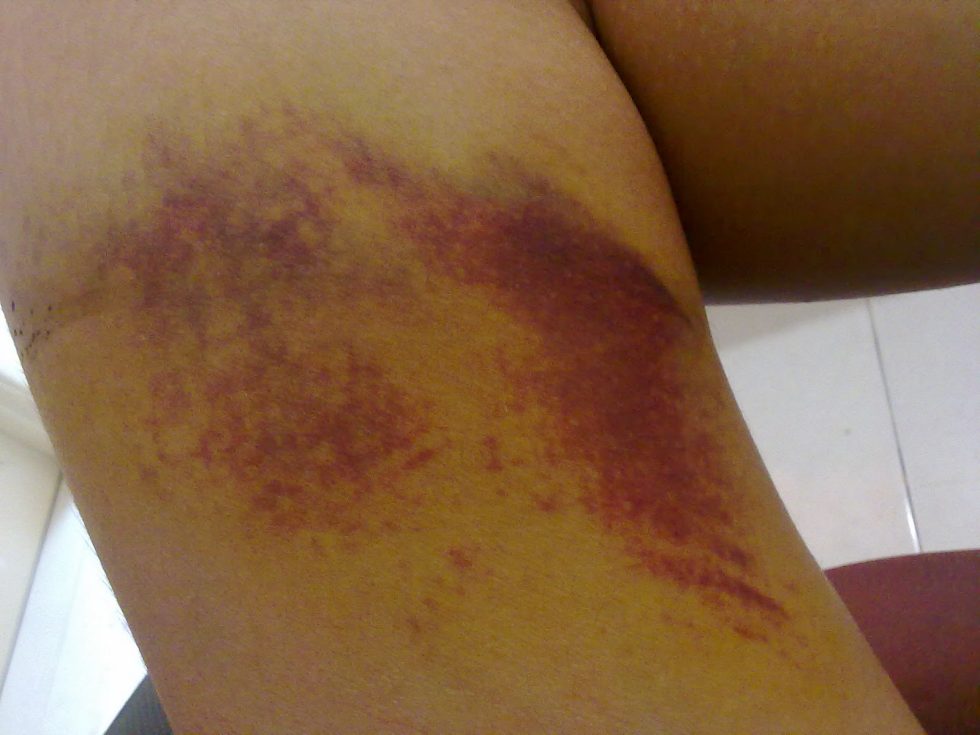 Purpura Simplex - Dermatologist consultation online - iDerma