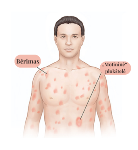 Pityriasis rosea - Dermatologist consultation online - iDerma