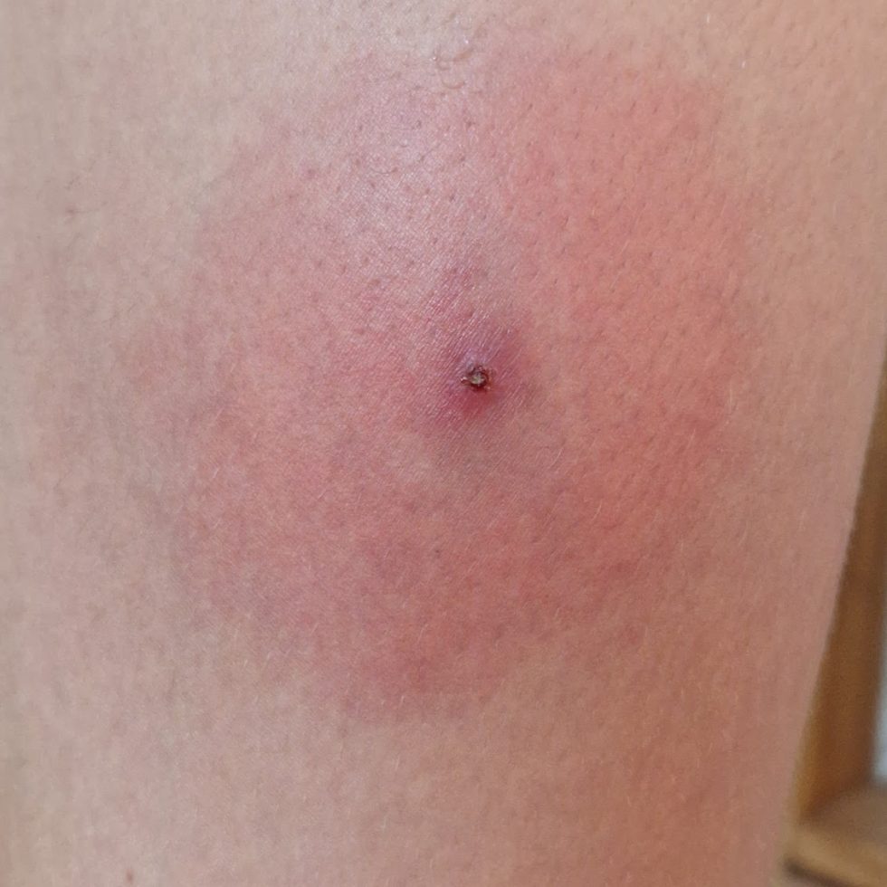 Laimo Liga: Simptomai, Diagnozė ir Gydymo Patarimai | iDerma