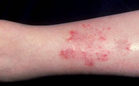 Stazinis Dermatitas: Priežastys, Simptomai ir Gydymo Patarimai | iDerma