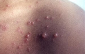 Vėjaraupiai: Simptomai, Priežastys ir Gydymo Būdai | iDerma