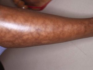 Vaskulitai: Priežastys, Simptomai ir Gydymo Galimybės | iDerma